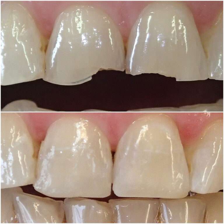 Before & After - Watercress Dental Clinic, Dentist in Alton Hampshire