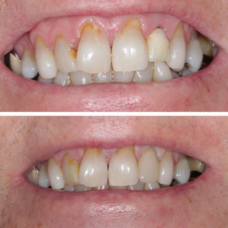 Before & After - Watercress Dental Clinic, Dentist in Alton Hampshire
